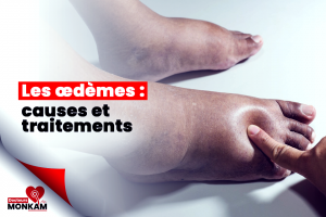 Œdème : causes, symptômes et traitements - Docteurs Monkam
