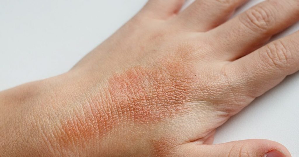 Problèmes de peau et travail : les causes des dermatoses ...